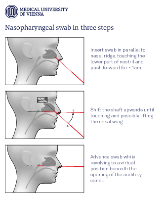 MedUni Vienna anatomical study: Nasopharyngeal swabs for diagnosing ...