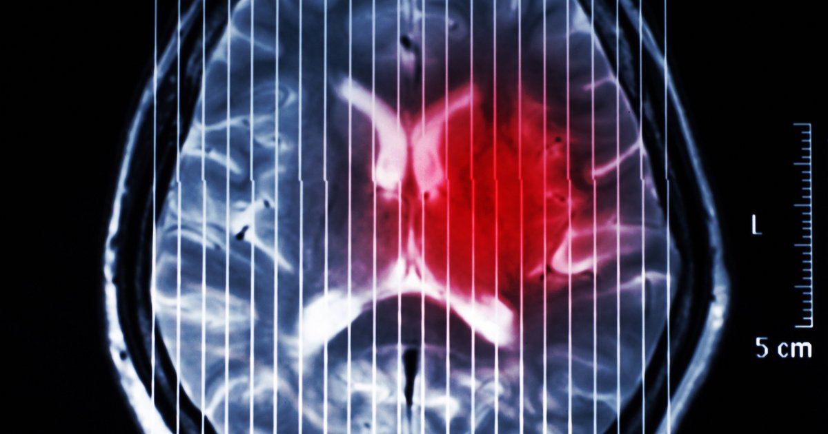 New therapeutic approach for aggressive type of brain tumor