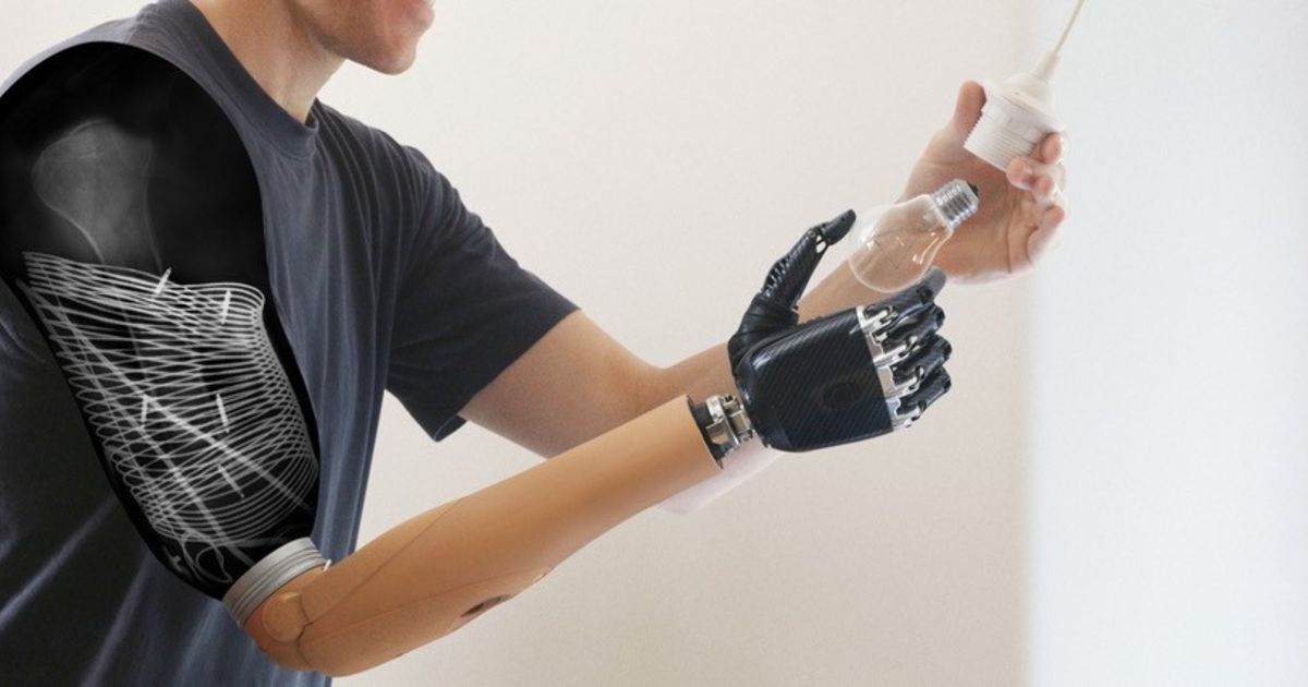 Prothetik: Erstmals Sensoren zur drahtlosen Muskelsignalübertragung ...