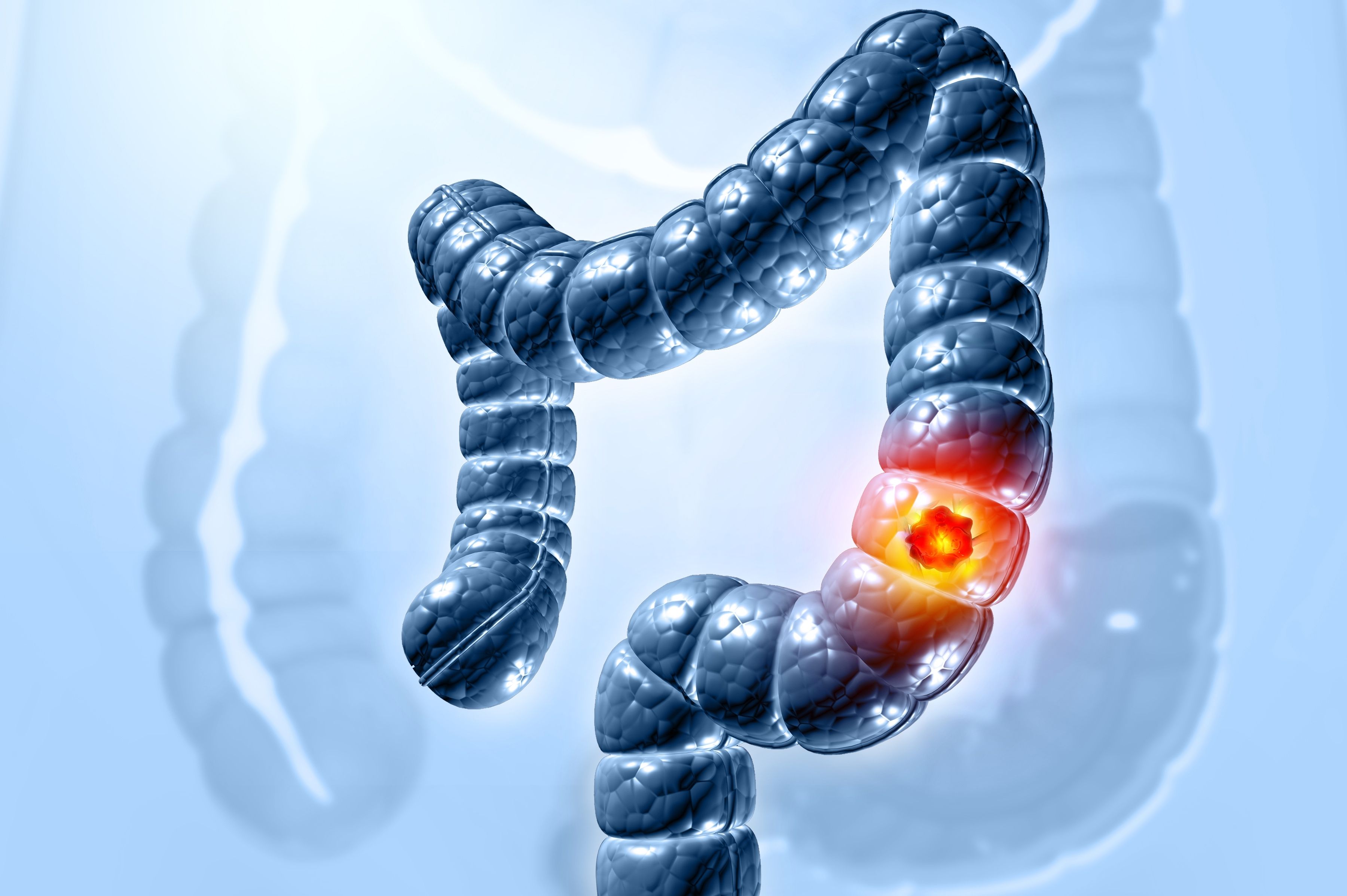Colorectal cancer: New approach for better efficacy of immunotherapies