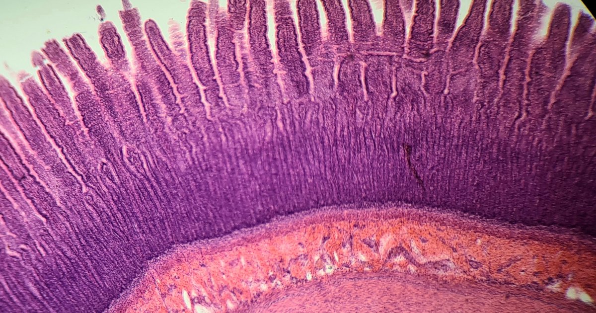 Possible trigger of chronic inflammatory bowel disease identified