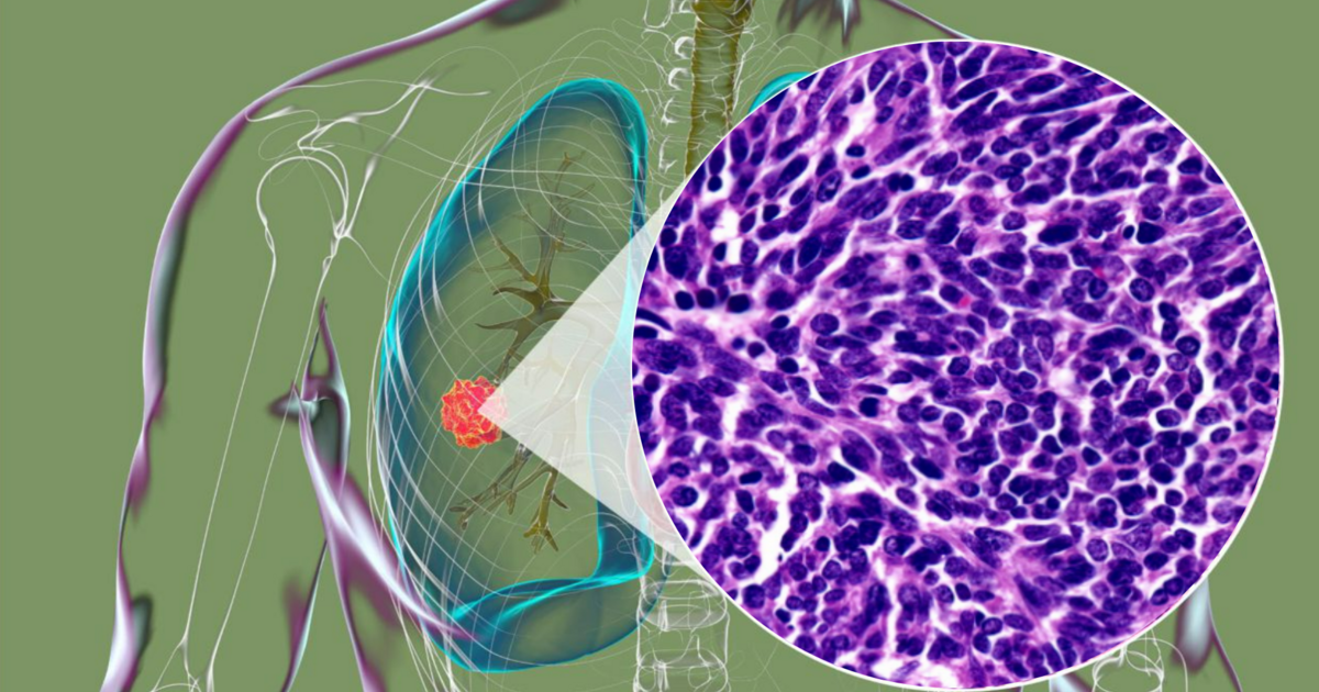 Small cell lung cancer: new approach to overcoming chemo-resistance