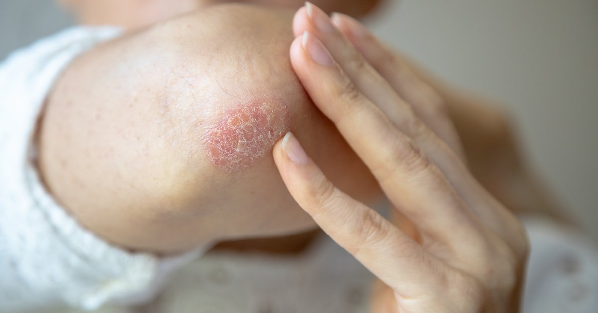 Neue Behandlungsmöglichkeit für Psoriasis erforscht