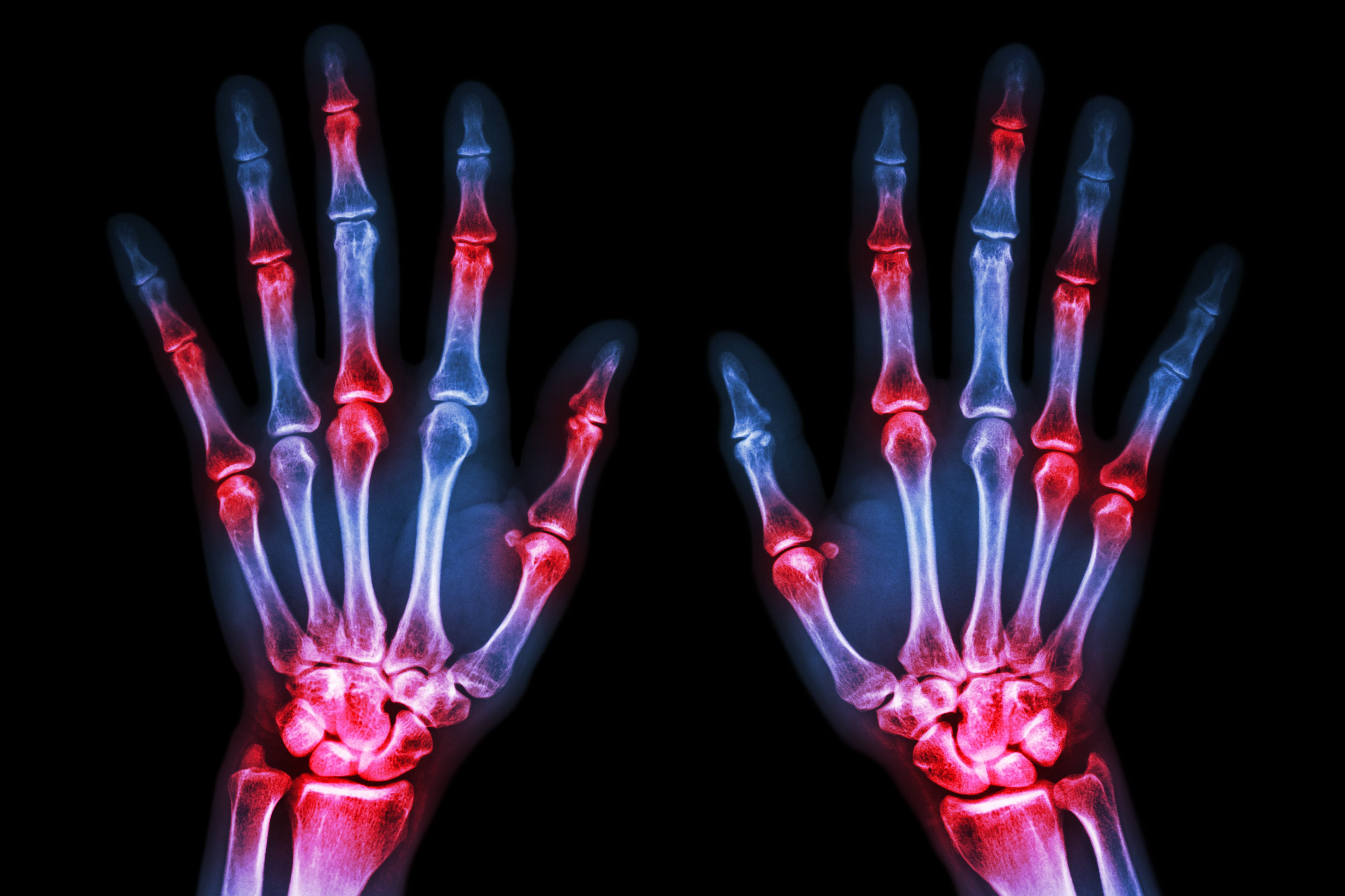 Rheumatoid arthritis: Arginine depletion as a starting point for ...